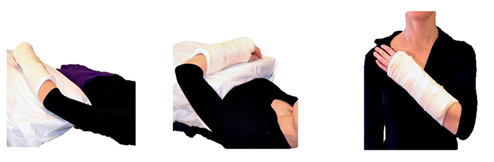 Värttinäluun alaosan murtuma eli rannemurtuma ja kipsaushoito ...