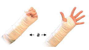 Värttinäluun alaosan murtuma eli rannemurtuma ja leikkaushoito ...