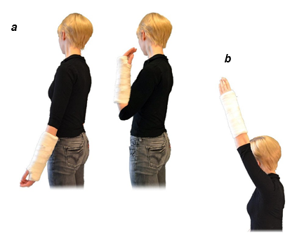 Värttinäluun alaosan murtuma eli rannemurtuma ja leikkaushoito ...